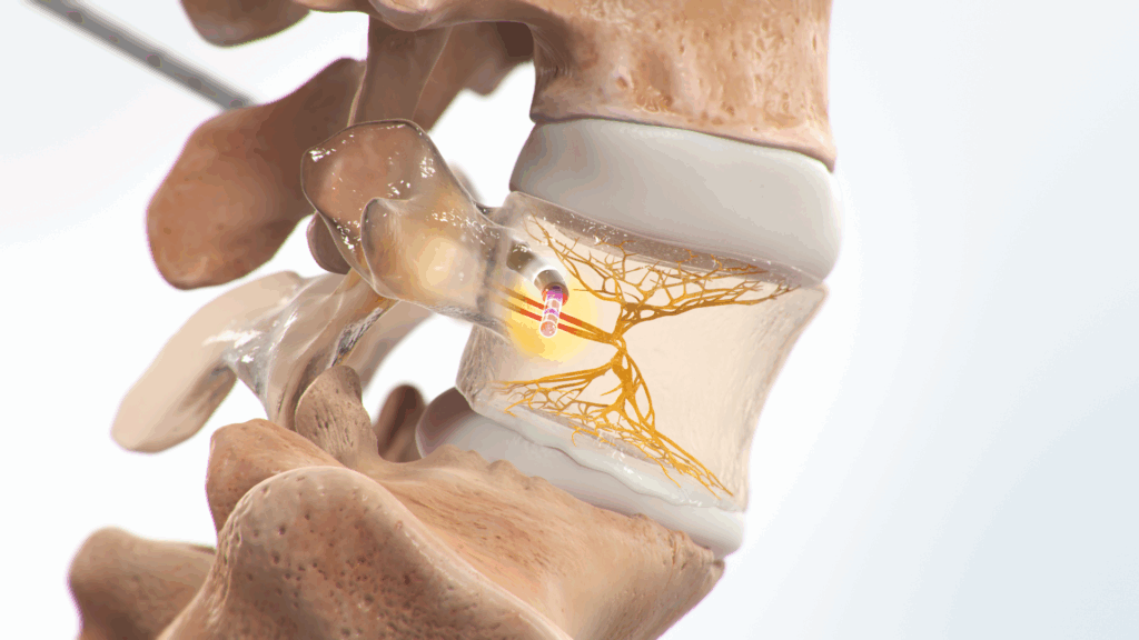 Basivertebral Nerve Ablation (Intracept) - Center for Interventional Pain & Spine